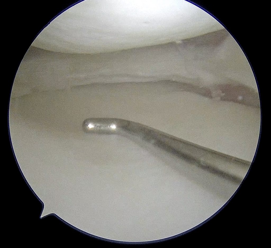 What is ‘pie-crusting the MCL’? - Knee Arthroscopy in London