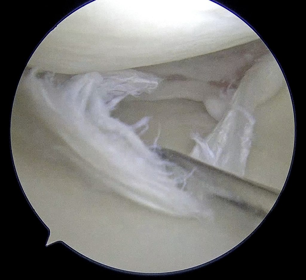 What is ‘pie-crusting the MCL’? - Knee Arthroscopy in London